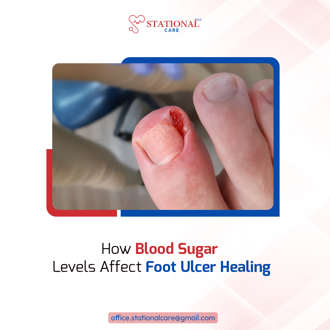 How Blood Sugar Levels Affect Foot Ulcer Healing?Stational Care